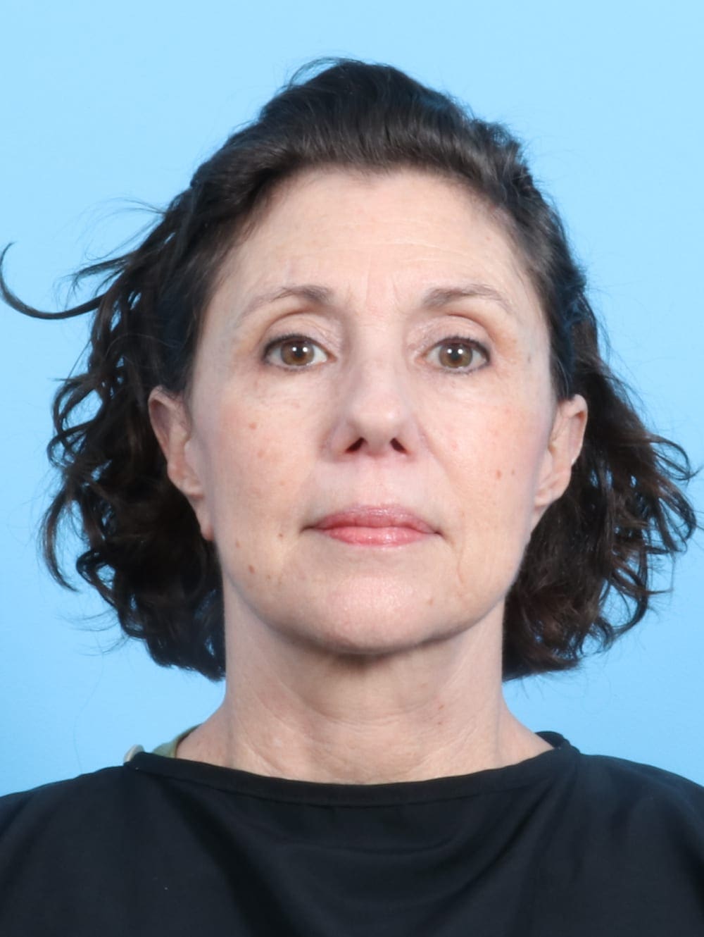 Case 20185 - Facelift / Neck Lift | Folsom, CA